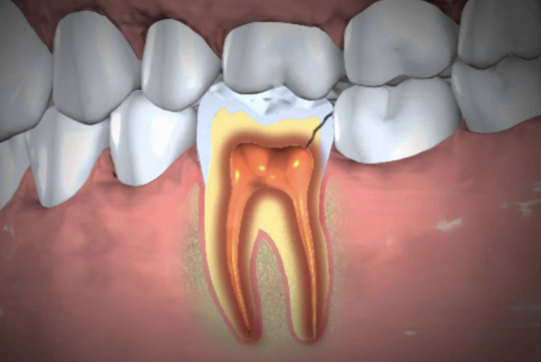 Cómo saber si es un absceso dental | Urgencias dentales