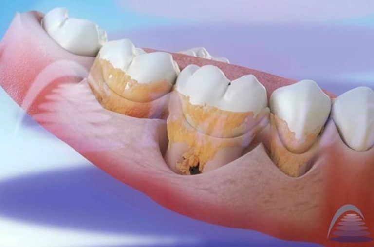 Cómo saber si tengo sarro subgingival | Urgencias dentales