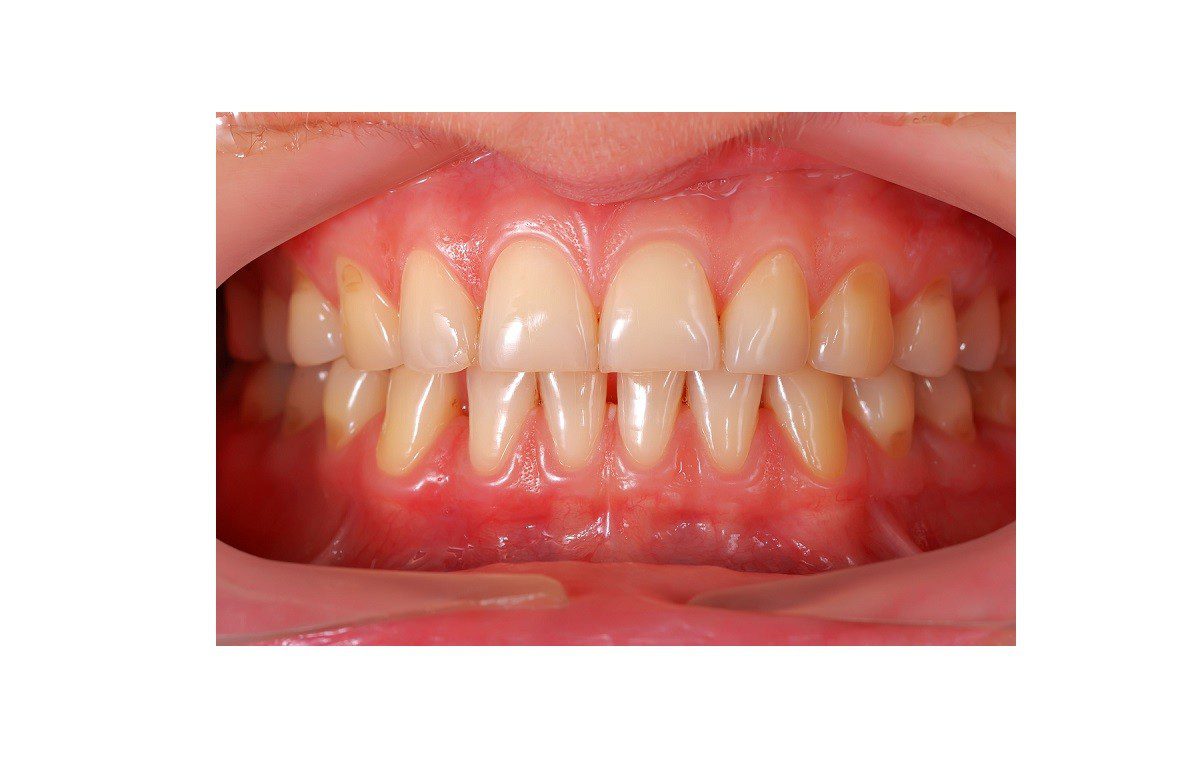 Cuánto dura el tratamiento de la gingivitis | Urgencias dentales