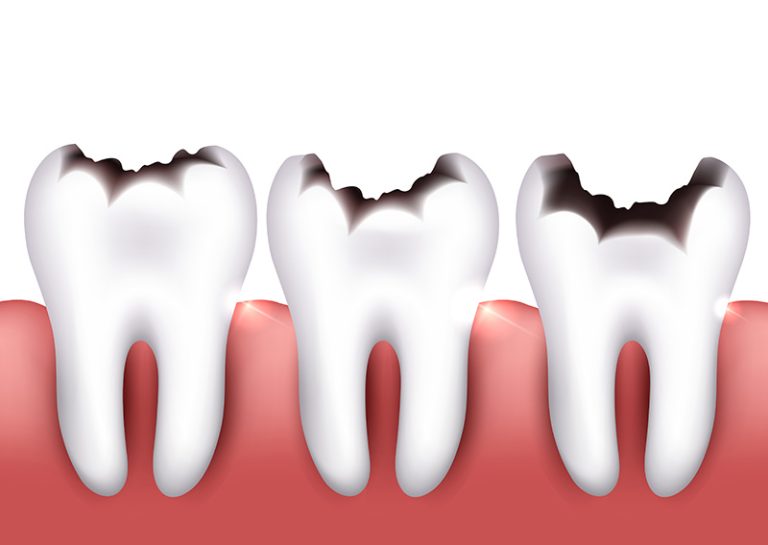 Cómo saber qué grado de caries tengo | Urgencias dentales