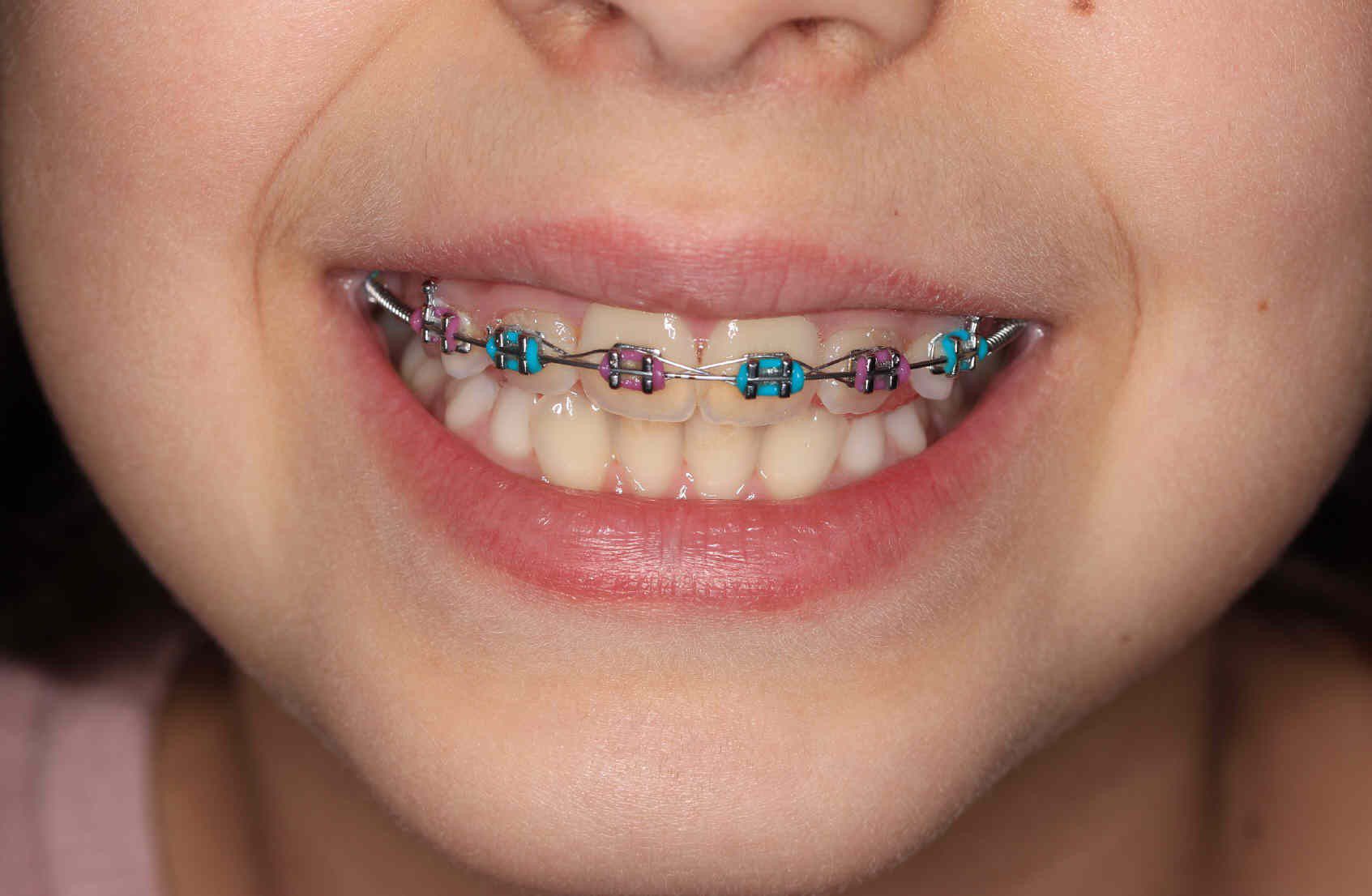 Qué colores no usar en brackets | Urgencias dentales
